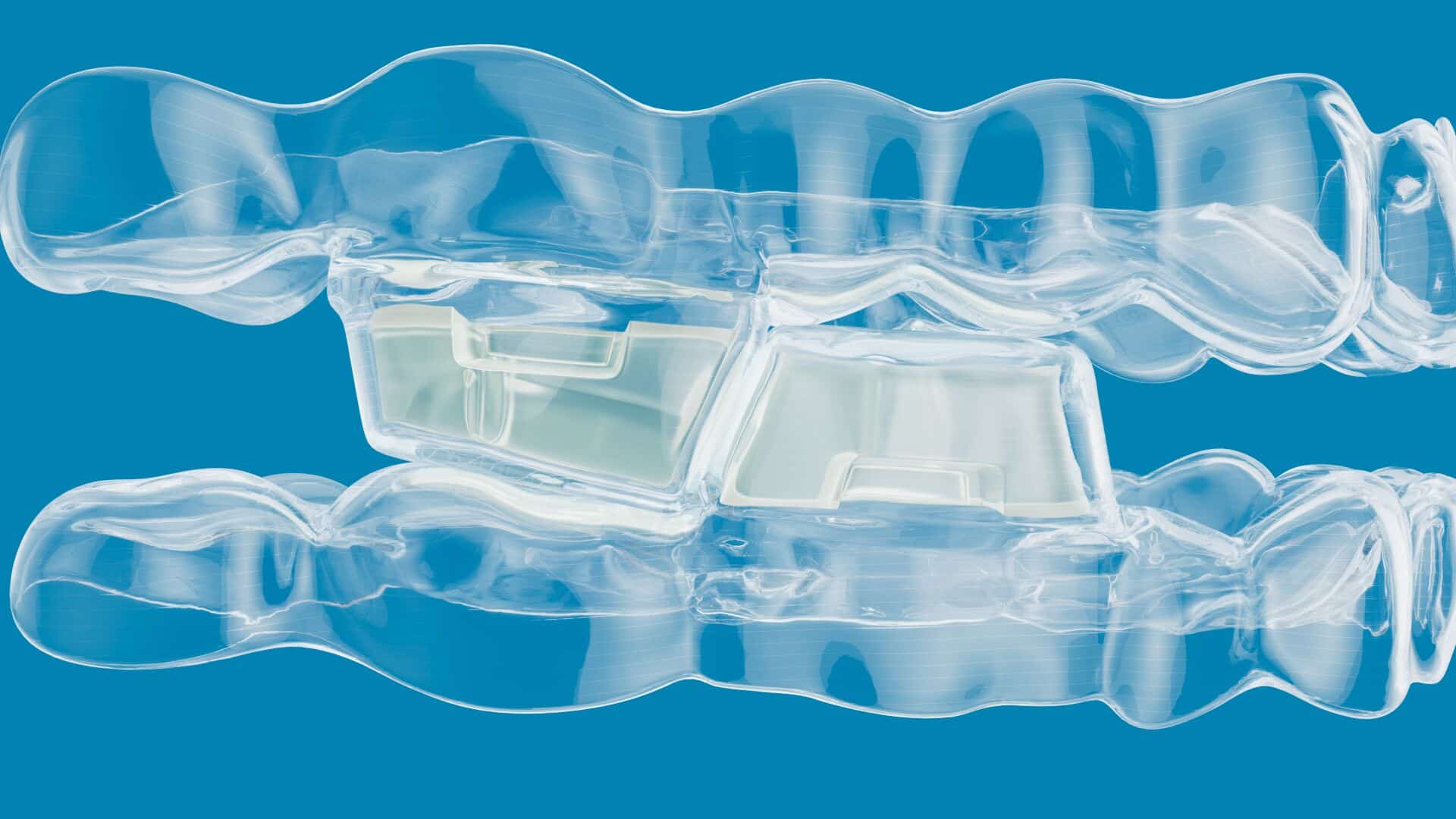 Align Technology Releases Invisalign System with Occlusal Blocks