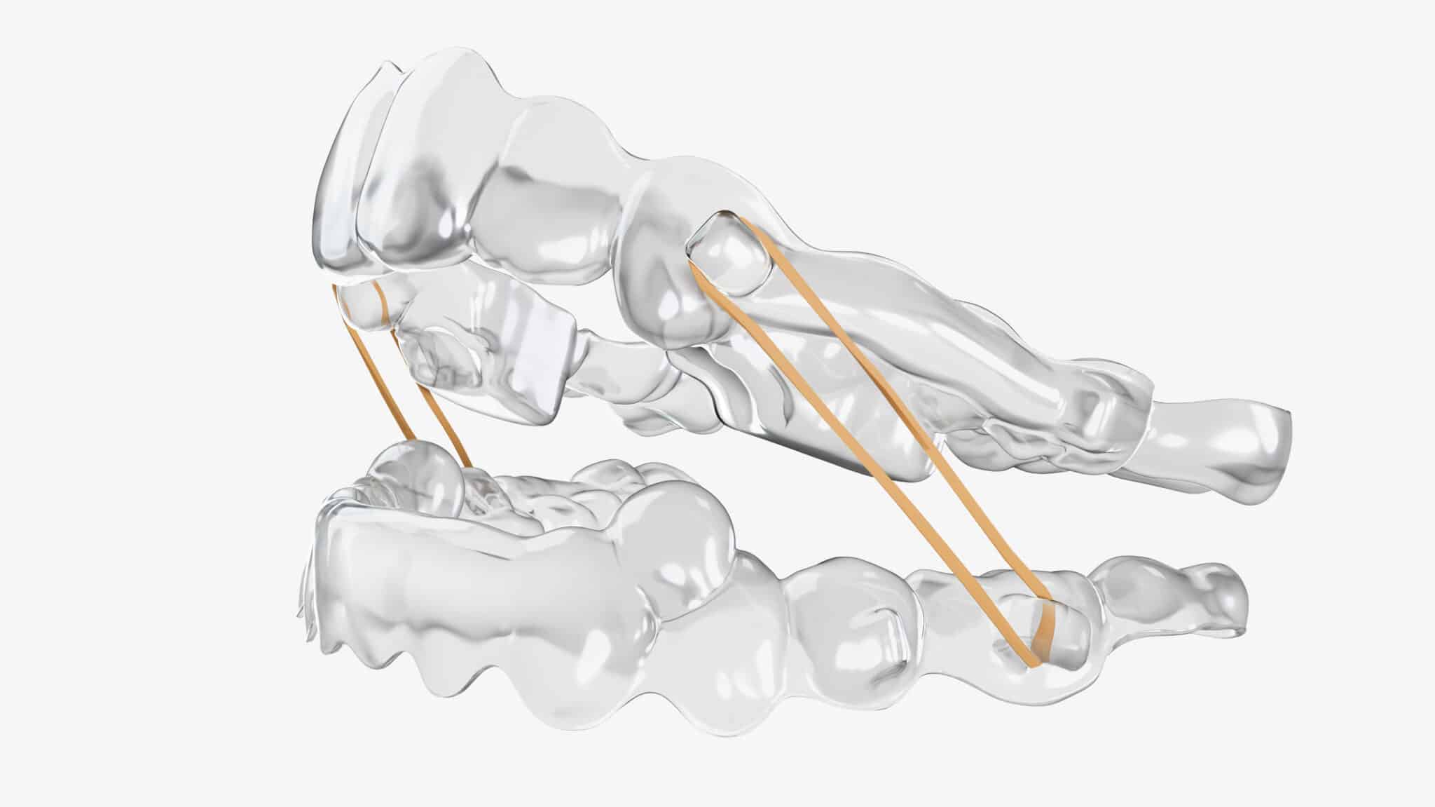 Ormco Unveils Spark Retainers and BiteSync Class II Corrector at AAO