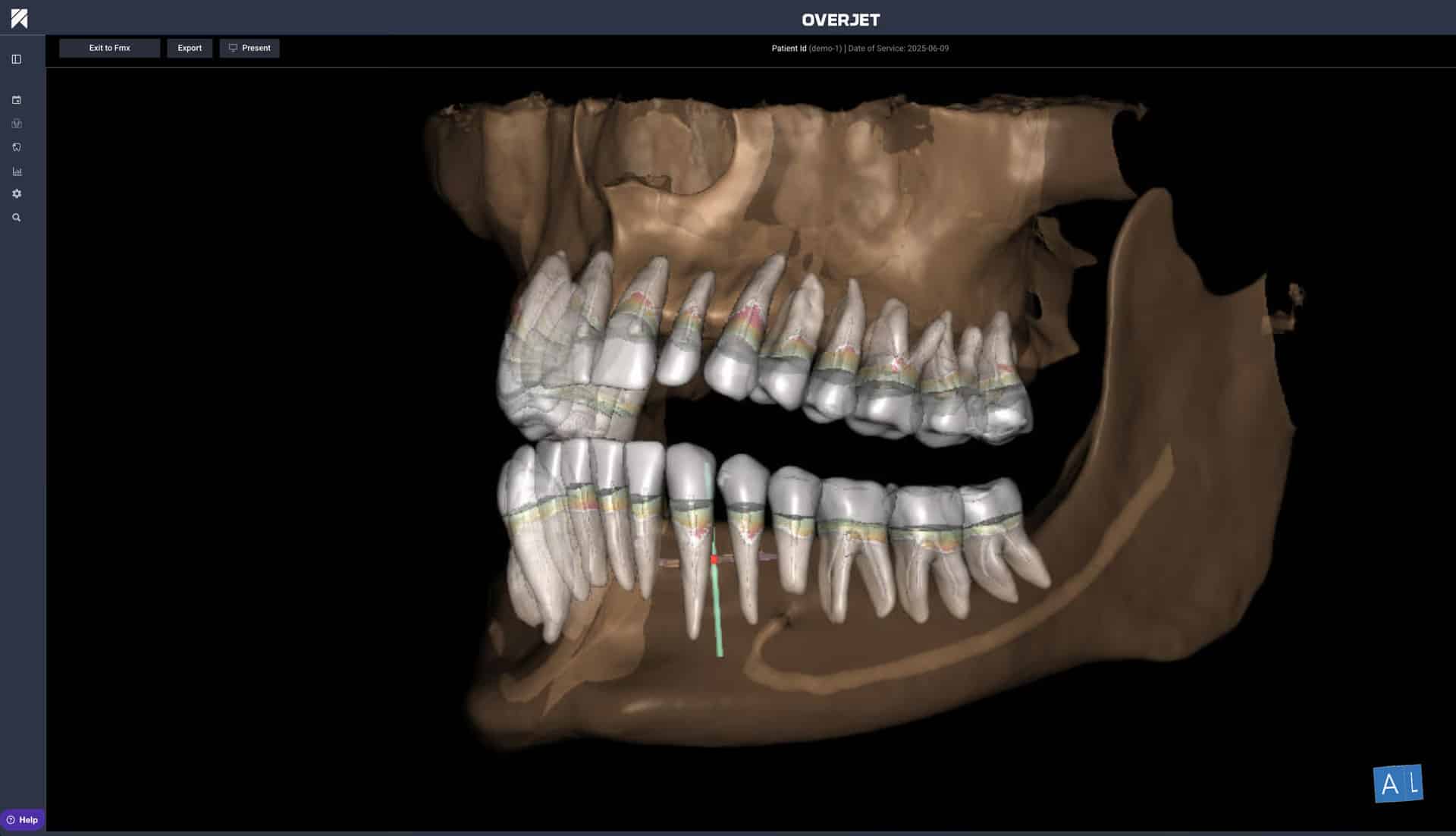 FDA Clears Overjet’s CBCT Assist AI Platform